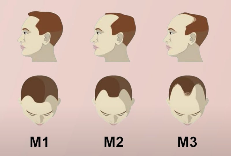 광화문 탈모 자가진단법 - BASP 분류법 : 네이버 블로그