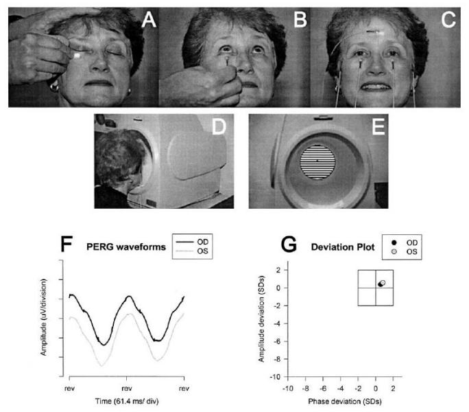 부천안과 녹내장 진료 장비의 중요한 퍼즐 : Pattern ERG(격자무늬자극 망막전위도검사) : 네이버 블로그