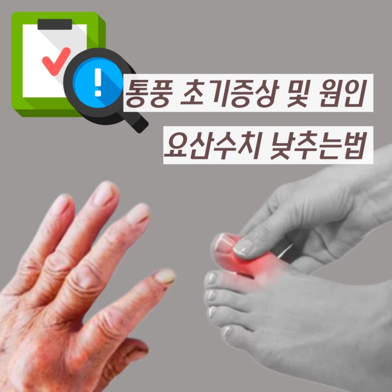통풍 초기 증상 및 원인 W 요산수치 낮추는법 네이버 블로그