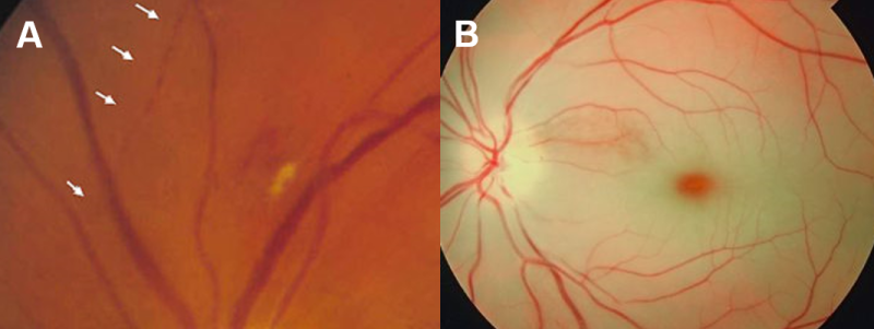 [EYE잘보여] 망막동맥폐쇄 (1) - 망막중심동맥폐쇄(Central Retinal Artery Occlusion; CRAO ...