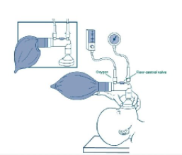 신생아 심폐소생술, neonatal resuscitation 에 관하여(2) - CPAP과 PPV(postive pressure ...