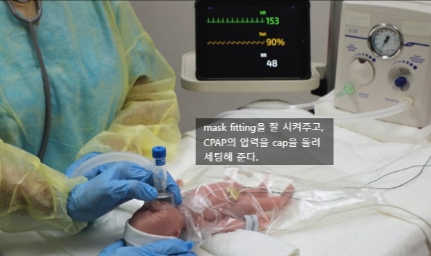 신생아 심폐소생술, neonatal resuscitation 에 관하여(2) - CPAP과 PPV(postive pressure ...