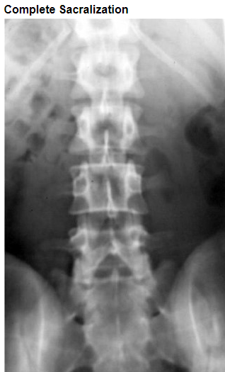 [요추] lumbosacral transitional vertebrae, Sacralization, Lumbarization ...