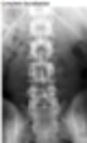 [요추] lumbosacral transitional vertebrae, Sacralization, Lumbarization ...