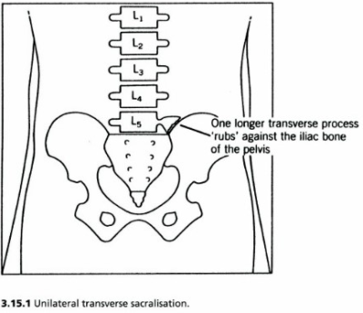 [요추] lumbosacral transitional vertebrae, Sacralization, Lumbarization ...