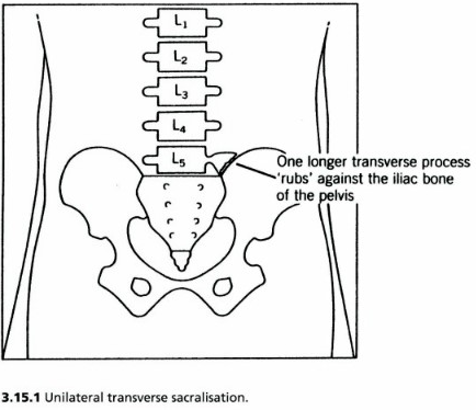 [요추] lumbosacral transitional vertebrae, Sacralization, Lumbarization ...