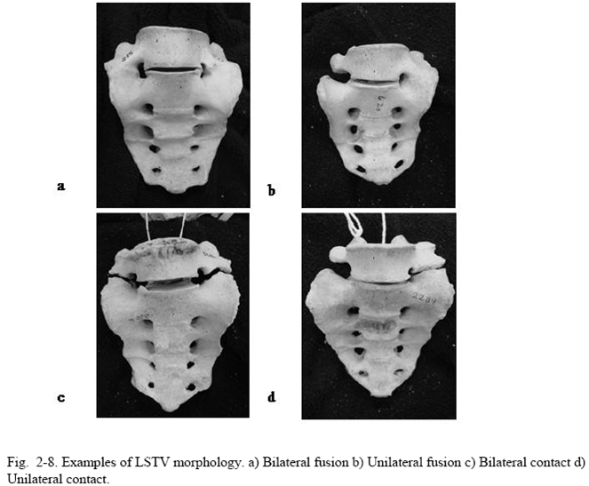 [요추] lumbosacral transitional vertebrae, Sacralization, Lumbarization ...