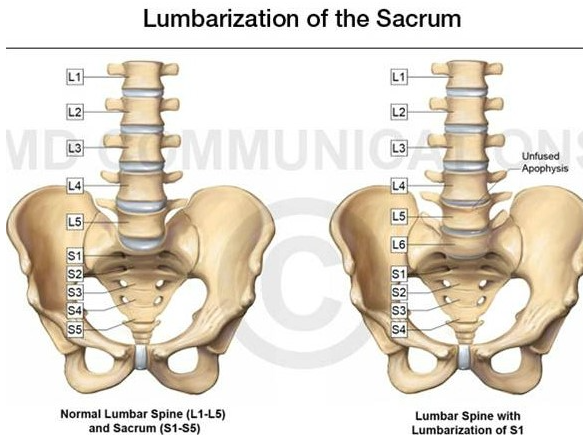 [요추] lumbosacral transitional vertebrae, Sacralization, Lumbarization ...