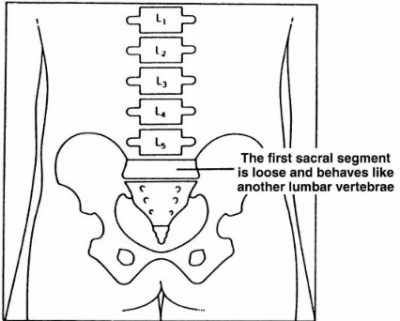 [요추] lumbosacral transitional vertebrae, Sacralization, Lumbarization ...