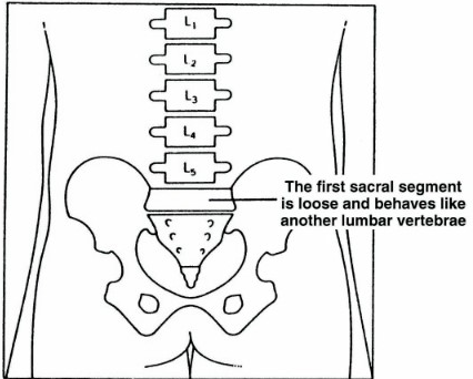 [요추] lumbosacral transitional vertebrae, Sacralization, Lumbarization ...