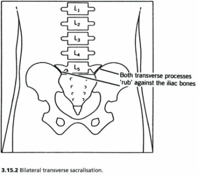 [요추] lumbosacral transitional vertebrae, Sacralization, Lumbarization ...