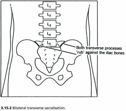 [요추] lumbosacral transitional vertebrae, Sacralization, Lumbarization ...