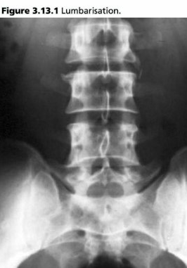 [요추] lumbosacral transitional vertebrae, Sacralization, Lumbarization ...