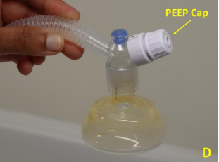 신생아 심폐소생술, neonatal resuscitation 에 관하여(2) - CPAP과 PPV(postive pressure ...