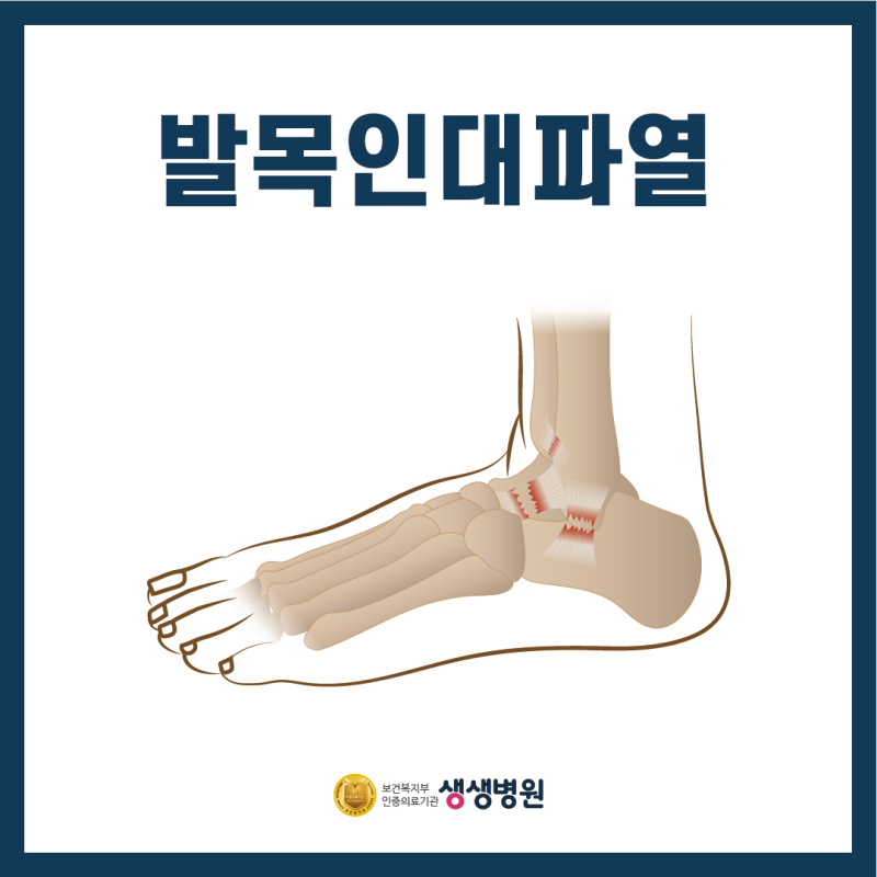 부천 정형외과 발목 인대 파열 증상 수술 발목 인대 찢어짐 늘어났을 때 재건술 네이버 블로그