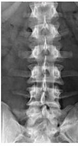 [요추] lumbosacral transitional vertebrae, Sacralization, Lumbarization ...