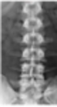 [요추] lumbosacral transitional vertebrae, Sacralization, Lumbarization ...