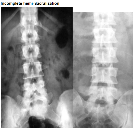 [요추] lumbosacral transitional vertebrae, Sacralization, Lumbarization ...