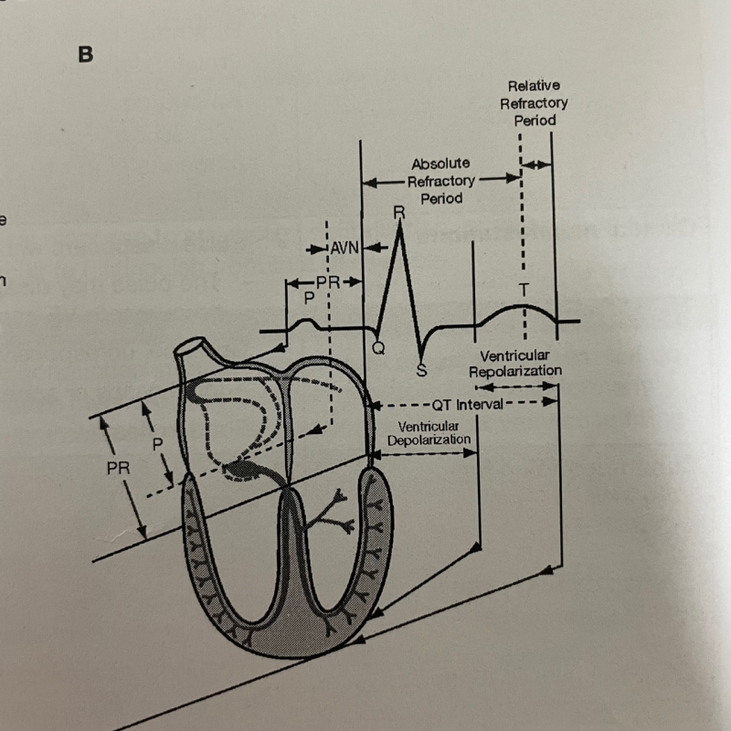 ACLS provider 알아야할 지식(3)_ ECG, ACLS Core Rhythms, 부정맥, Arrest : 네이버 블로그