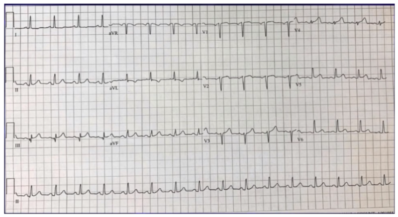 [심전도] Wellens' pattern 또는 LAD -T wave inversion pattern : 네이버 블로그