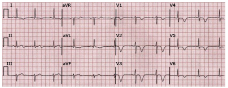 [심전도] Wellens' pattern 또는 LAD -T wave inversion pattern : 네이버 블로그