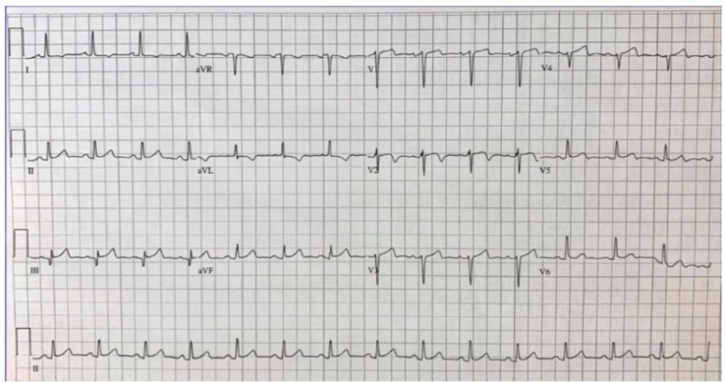 [심전도] Wellens' pattern 또는 LAD -T wave inversion pattern : 네이버 블로그