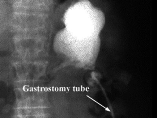 의학용어 PEG 쉽게 알아보기! : 네이버 블로그