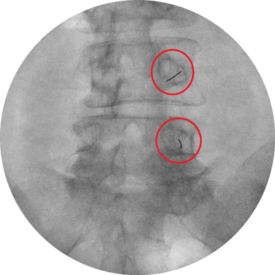 Lumbar MBB : 네이버 블로그