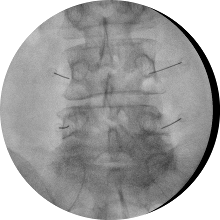Lumbar MBB : 네이버 블로그