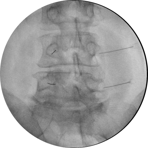 Lumbar MBB : 네이버 블로그
