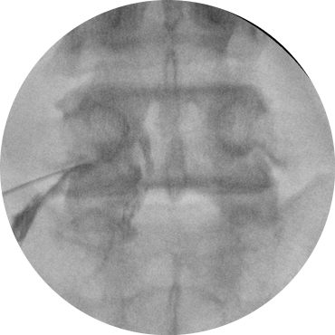 Lumbar selective nerve root block (SNRB) : 네이버 블로그