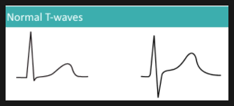 T wave : 네이버 블로그