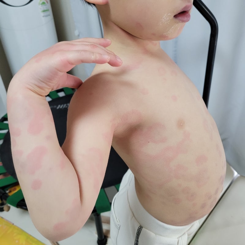 4세 아이 두드러기 원인 위장염과 알러지검사 항생제 부작용 네이버 블로그