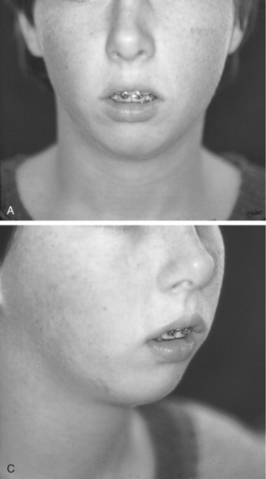 편히 닫히지 않는 입, 무거운 턱, 호두 주름 (2) - 입술 부전(Lip Incompetence) vs 턱끝 하수(Chin ...