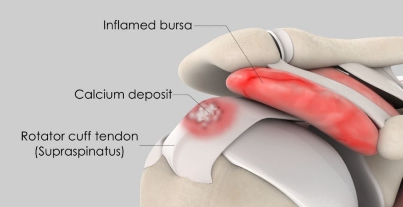[OS수술] Shoulder A/S Calcification Removal(석회화 제거술) : 네이버 블로그