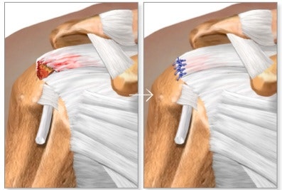 [OS수술] Shoulder A/S RCR(Rotator Cuff Repair, 회전근개 봉합술) : 네이버 블로그