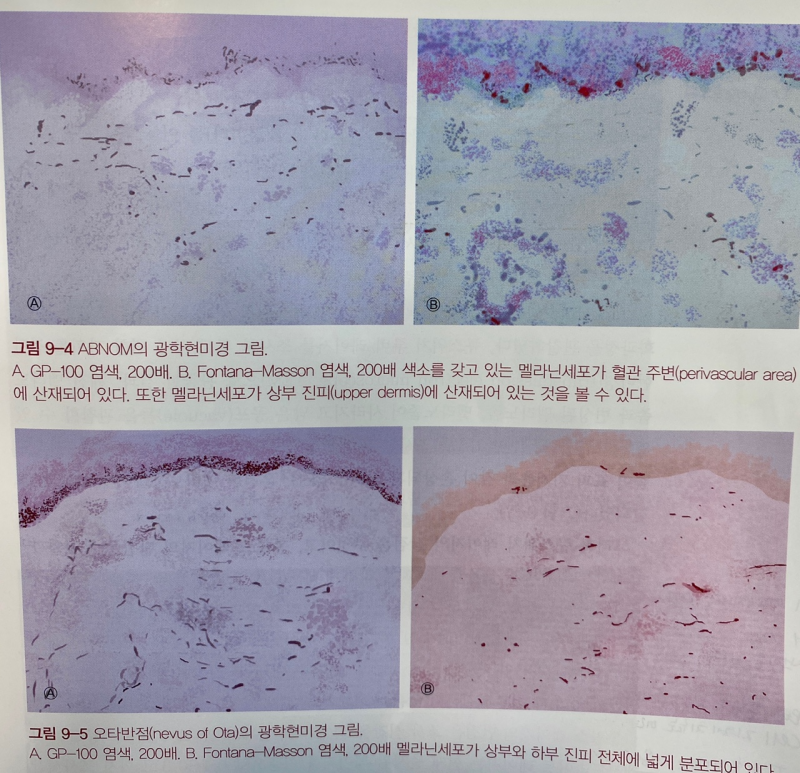 표피색소 치료 - Q스위치레이저 vs 롱펄스레이저 비교 : 네이버 블로그