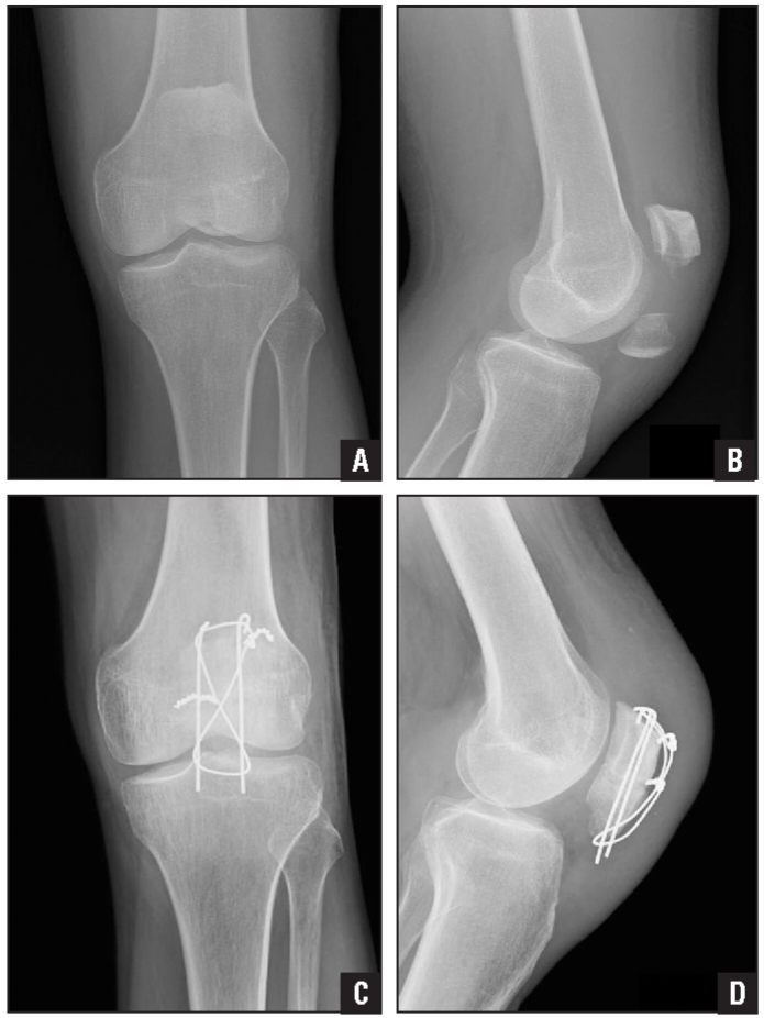 [OS수술] Patella ORIF - TBW(Tension Band Wiring) : 네이버 블로그