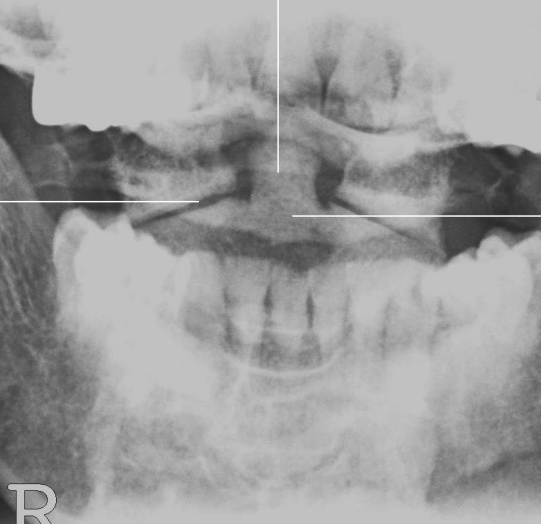 C spine (경추 촬영법) : 네이버 블로그