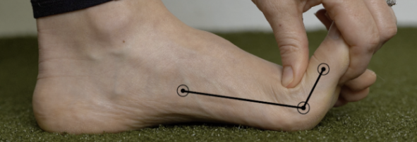 잔디 발가락(turf toe), 제1중족지관절 염좌(1st MTP joint sprain), 엄지발가락 통증 : 네이버 블로그