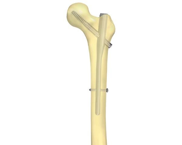 [OS수술] PFNA(Proximal Femoral Nail Antirotation, 항회전 근위 대퇴골 수정) : 네이버 블로그