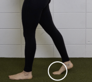 잔디 발가락(turf toe), 제1중족지관절 염좌(1st MTP joint sprain), 엄지발가락 통증 : 네이버 블로그