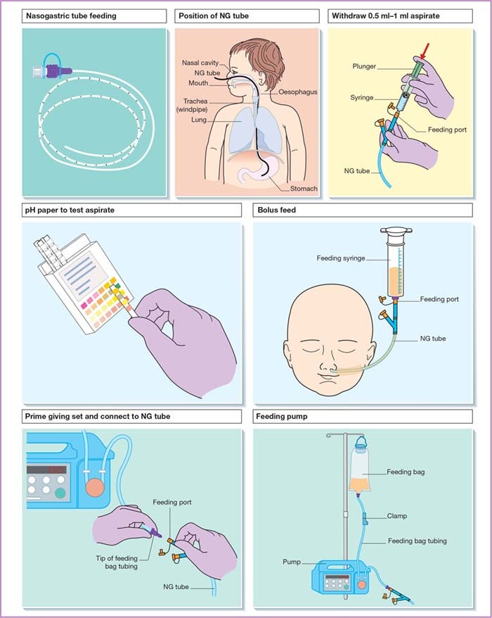 L-tube feeding 경관영양 방법, 자세, 관류, 잔류량, 순서, 합병증, 비위관 삽입 방법 : 네이버 블로그