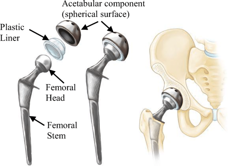 os-thra-total-hip-replacement-arthroplasty