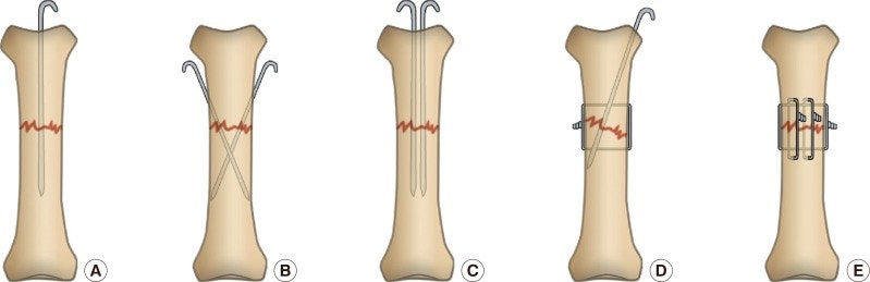 Foot CRPP : 네이버 블로그