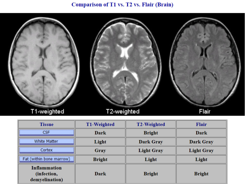 MRI (DWI,ADC - 급성 뇌경색 진단) : 네이버 블로그