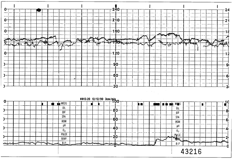 산부인과 태아사정 외부 태아 감시장치 External Fetal Monitoring 네이버 블로그