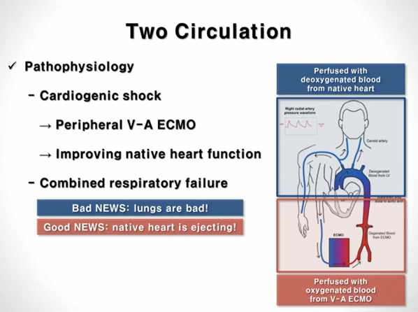 ECMO 기본이론_ ECMO mode 소개, 삽입 전후 간호, 모니터링, 합병증, weaning : 네이버 블로그