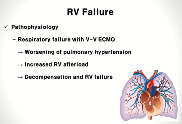 ECMO 기본이론_ ECMO mode 소개, 삽입 전후 간호, 모니터링, 합병증, weaning : 네이버 블로그