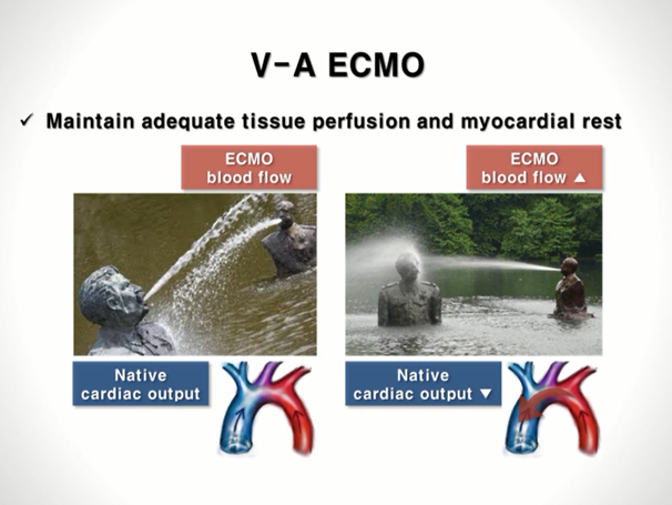 ECMO 기본이론_ ECMO mode 소개, 삽입 전후 간호, 모니터링, 합병증, weaning : 네이버 블로그